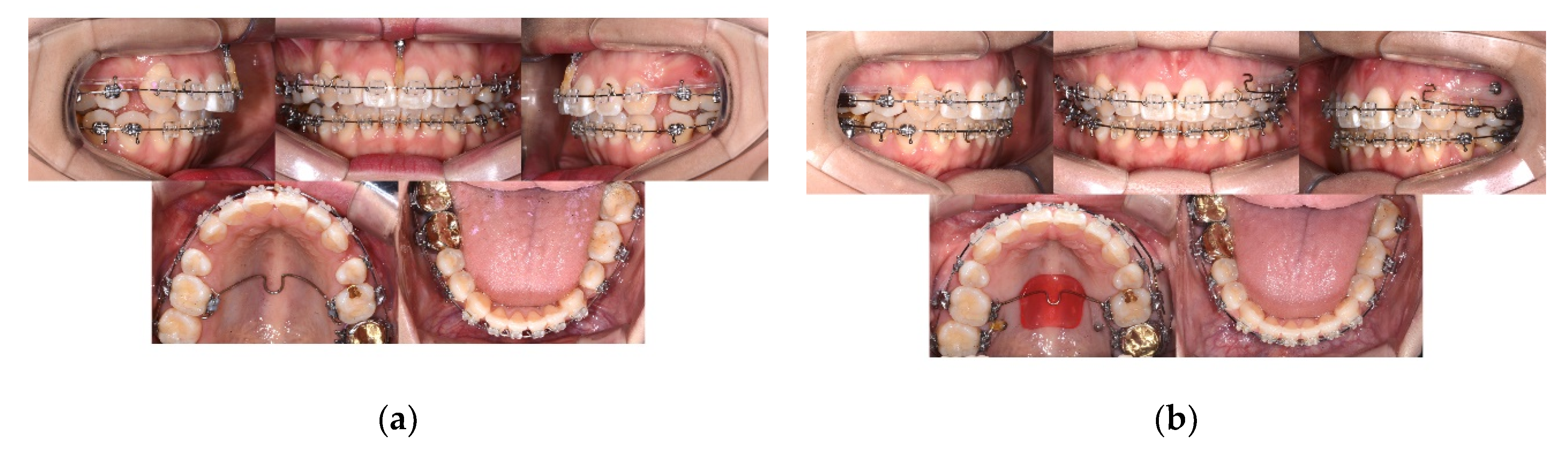 Applied Sciences | Free Full-Text | An Orthodontic Treatment Case of a TMD Patient with ...