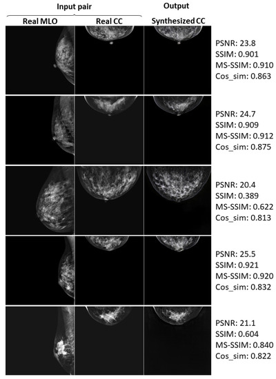 Two-View Mammogram Synthesis from Single-View Data Using Generative ...