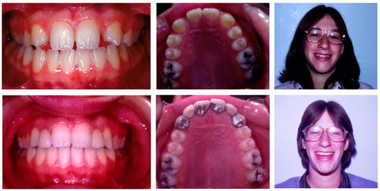 Prevalence and Patterns of Permanent Tooth Agenesis among Orthodontic ...