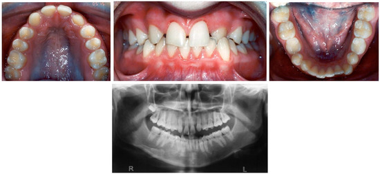 Prevalence and Patterns of Permanent Tooth Agenesis among Orthodontic ...