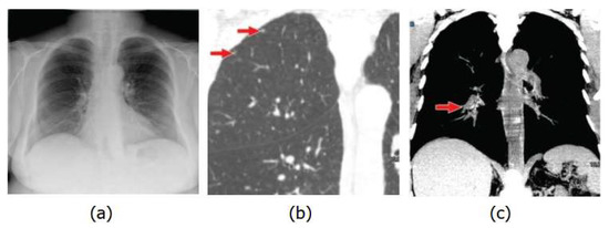 Lung Nodules Localization and Report Analysis from Computerized Tomography (CT) Scan Using a ...