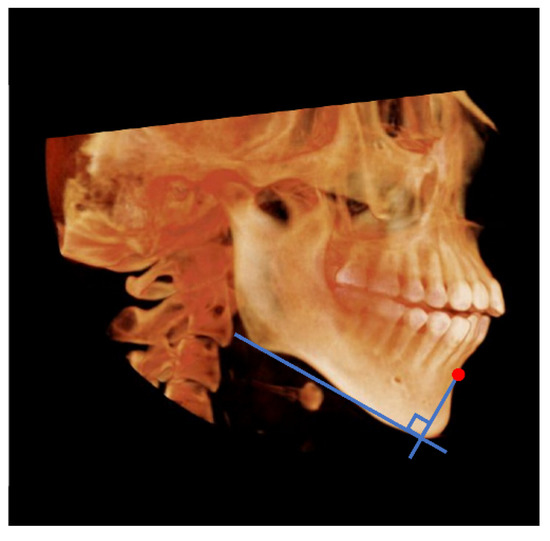 Chin Morphology in Relation to the Skeletal Pattern, Age, Gender, and ...