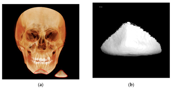 Chin Morphology in Relation to the Skeletal Pattern, Age, Gender, and ...