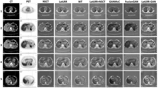 Hybrid Multimodal Medical Image Fusion Method Based on LatLRR and ED-D2GAN