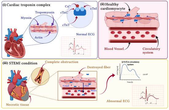 Analysis of a Cardiac-Necrosis-Biomarker Release in Patients with Acute ...