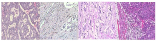 Multi-Class Breast Cancer Histopathological Image Classification Using Multi-Scale Pooled Image ...