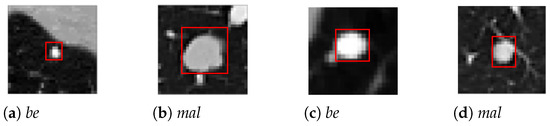 Multi-Granularity Dilated Transformer for Lung Nodule Classification via Local Focus Scheme