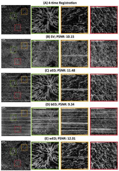 Windowed Eigen-Decomposition Algorithm for Motion Artifact Reduction in ...