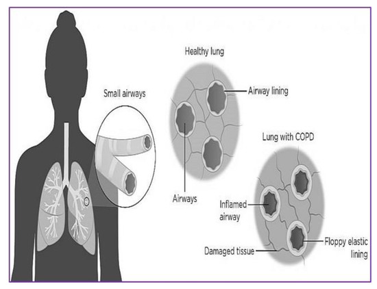 Analysis of Breath-Holding Capacity for Improving Efficiency of COPD Severity-Detection Using ...