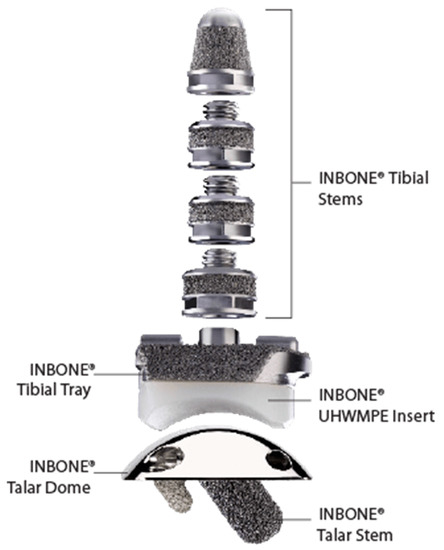 A Review Study on Total Ankle Replacement