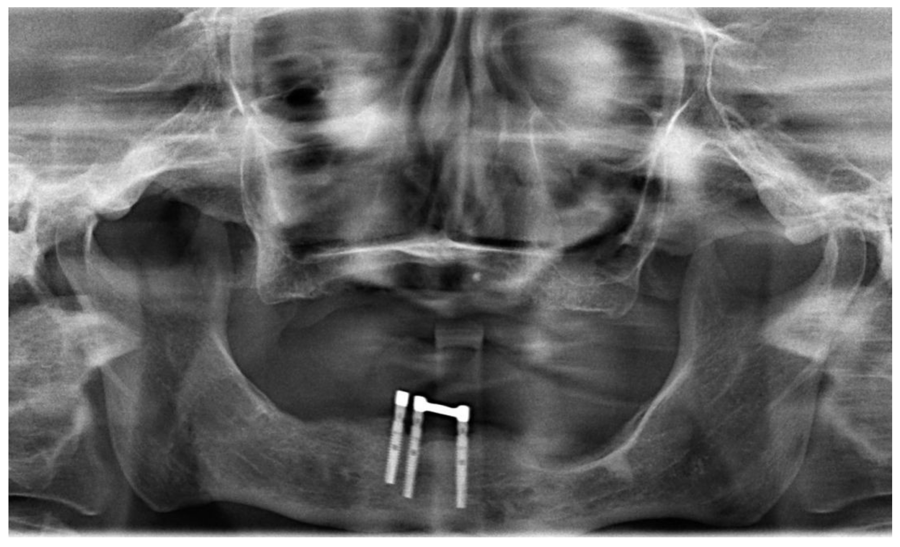 Clinical Reliability of Complete-Arch Fixed Prostheses Supported by ...