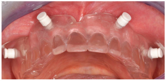 Clinical Reliability of Complete-Arch Fixed Prostheses Supported by ...