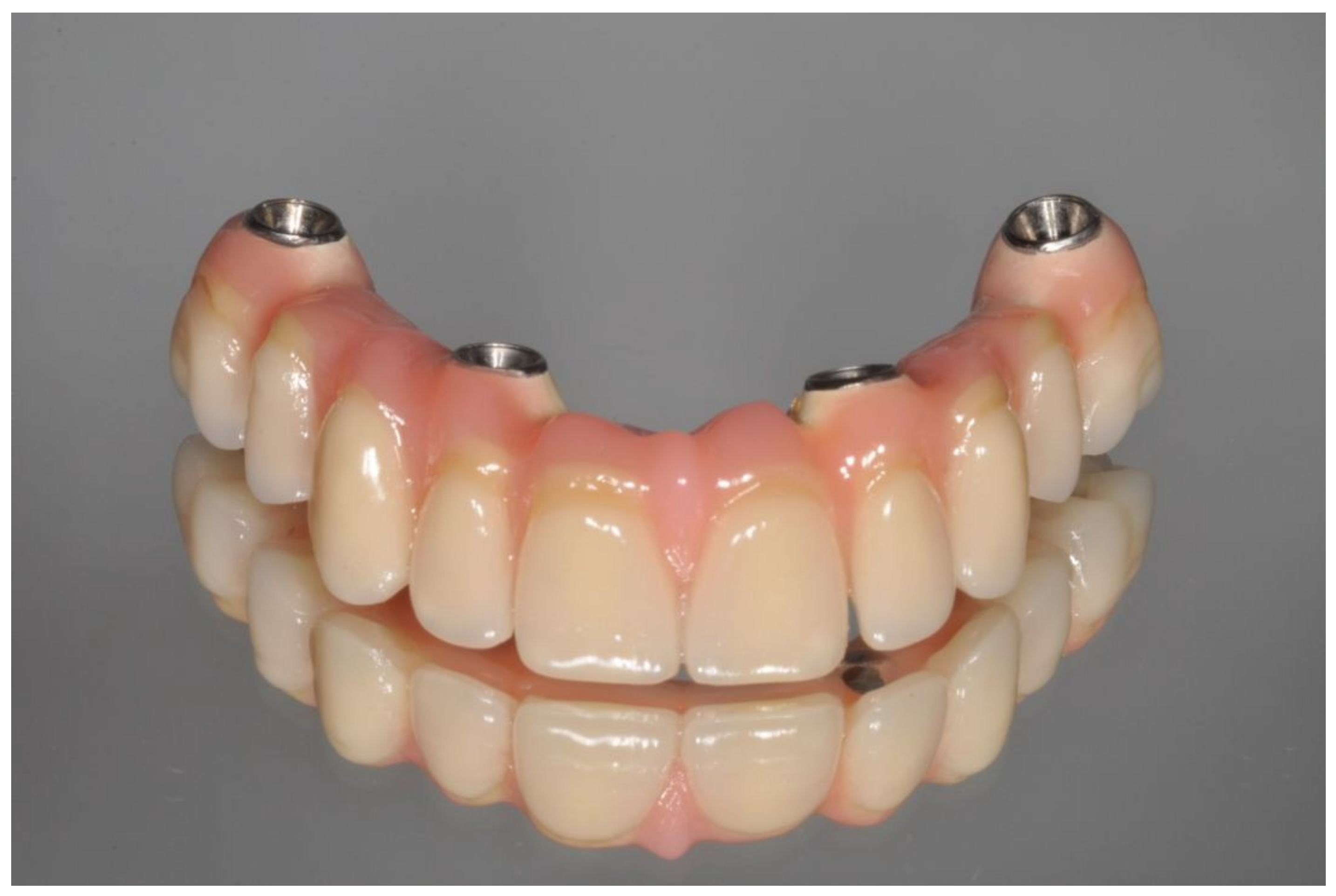 Clinical Reliability of Complete-Arch Fixed Prostheses Supported by ...