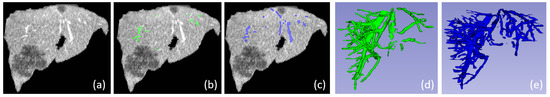 Automatic Hepatic Vessels Segmentation Using RORPO Vessel Enhancement ...