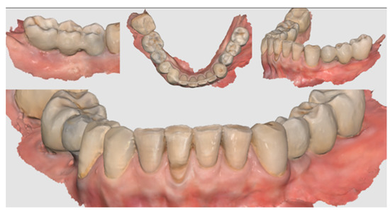 Restoration of Severe Bone and Soft Tissue Atrophy by Means of a ...