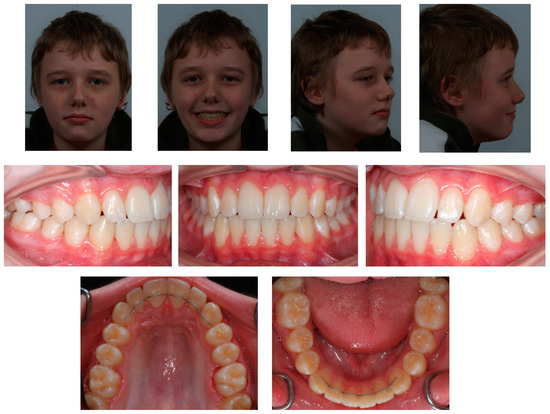 Fixed Flexible Spiral Wire Retainers and Unwanted Tooth Movements: A ...