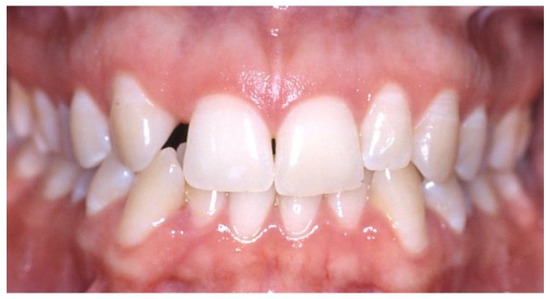 Implant–Prosthetic Rehabilitation of Maxillary Lateral Incisor Agenesis ...