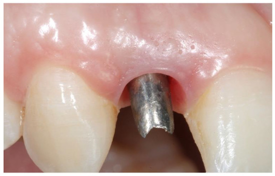 Implant–Prosthetic Rehabilitation of Maxillary Lateral Incisor Agenesis ...