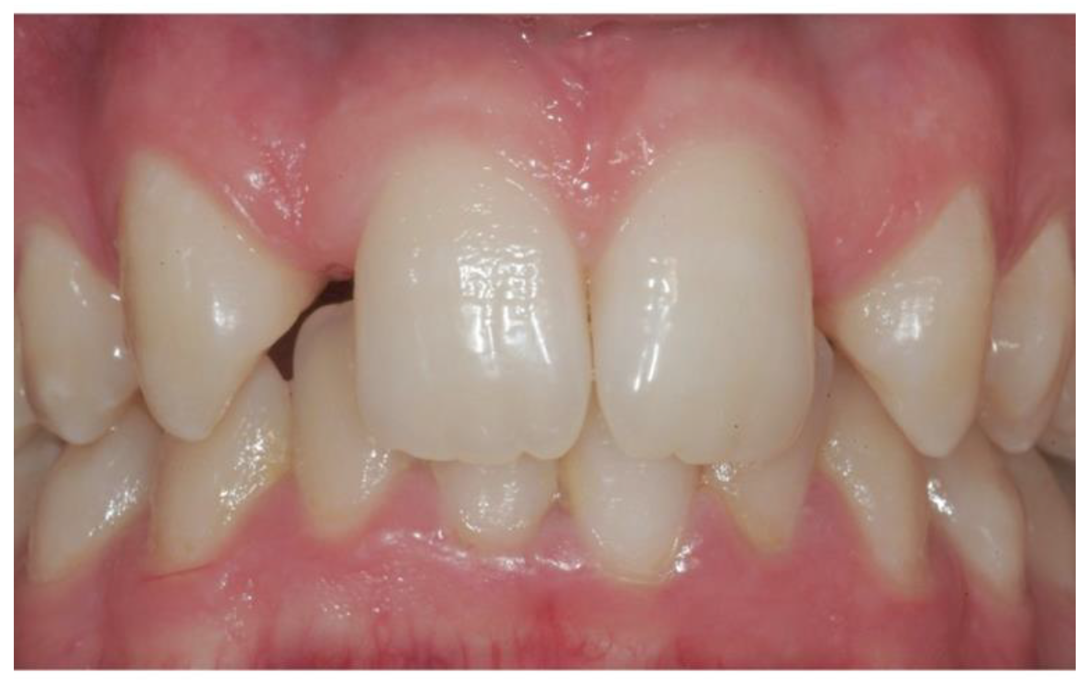 Implant–Prosthetic Rehabilitation of Maxillary Lateral Incisor Agenesis ...