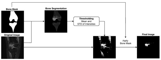 Learning Models for Bone Marrow Edema Detection in Magnetic Resonance ...