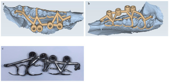 3D-Printed Metal Surgical Guide for Endodontic Microsurgery (a Proof of ...