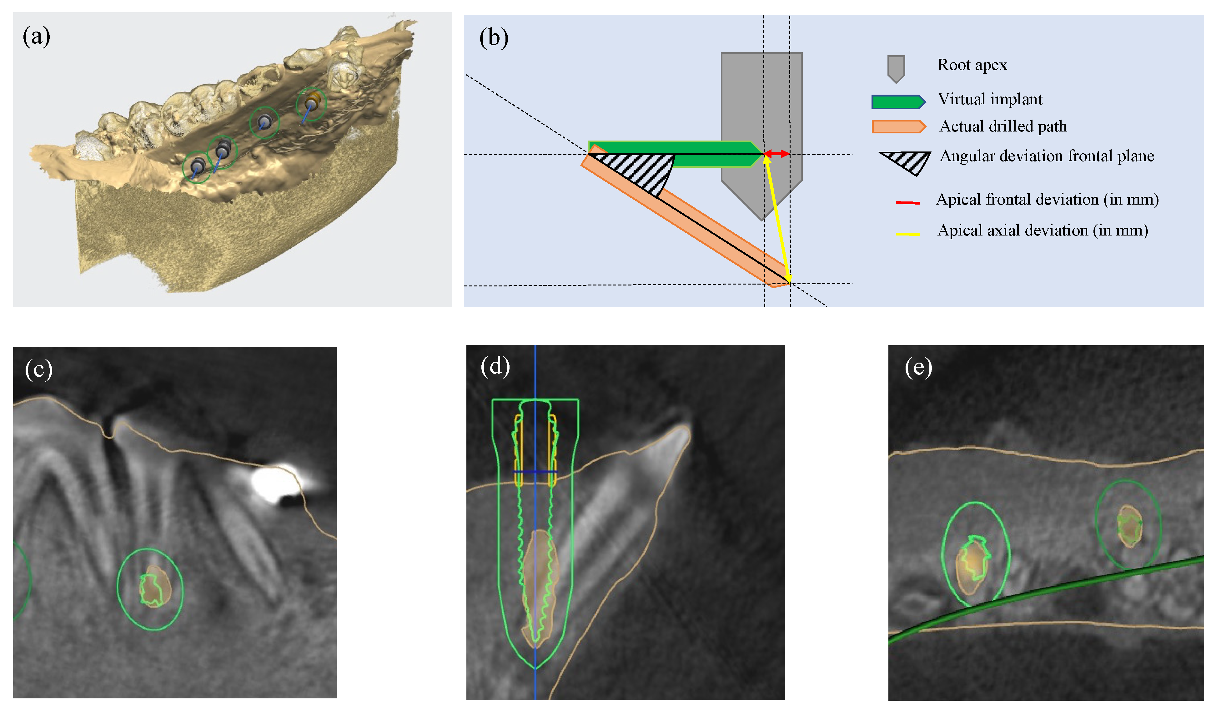 3D-Printed Metal Surgical Guide for Endodontic Microsurgery (a Proof of ...
