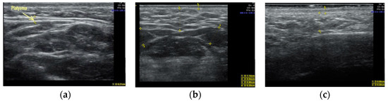Possibilities of Ultrasound Examination in the Assessment of Age ...