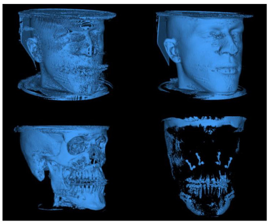 Realistic Facial Three-Dimensional Reconstruction from CT Images and 2D ...