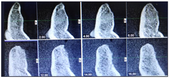 Fresh–Frozen Allogenic Bone Graft Usage in Treatment of an Odontogenic ...