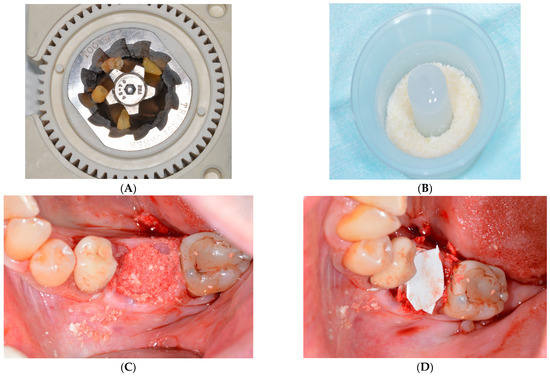 Innovative Alveolar Socket Preservation Procedure Using Demineralized Tooth Dentin as Graft ...