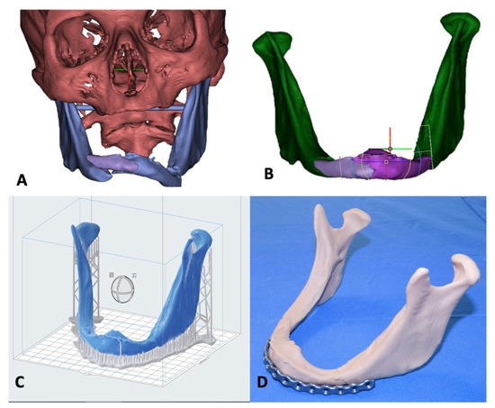 Applied Sciences Free Full Text Virtual Surgical Reduction In