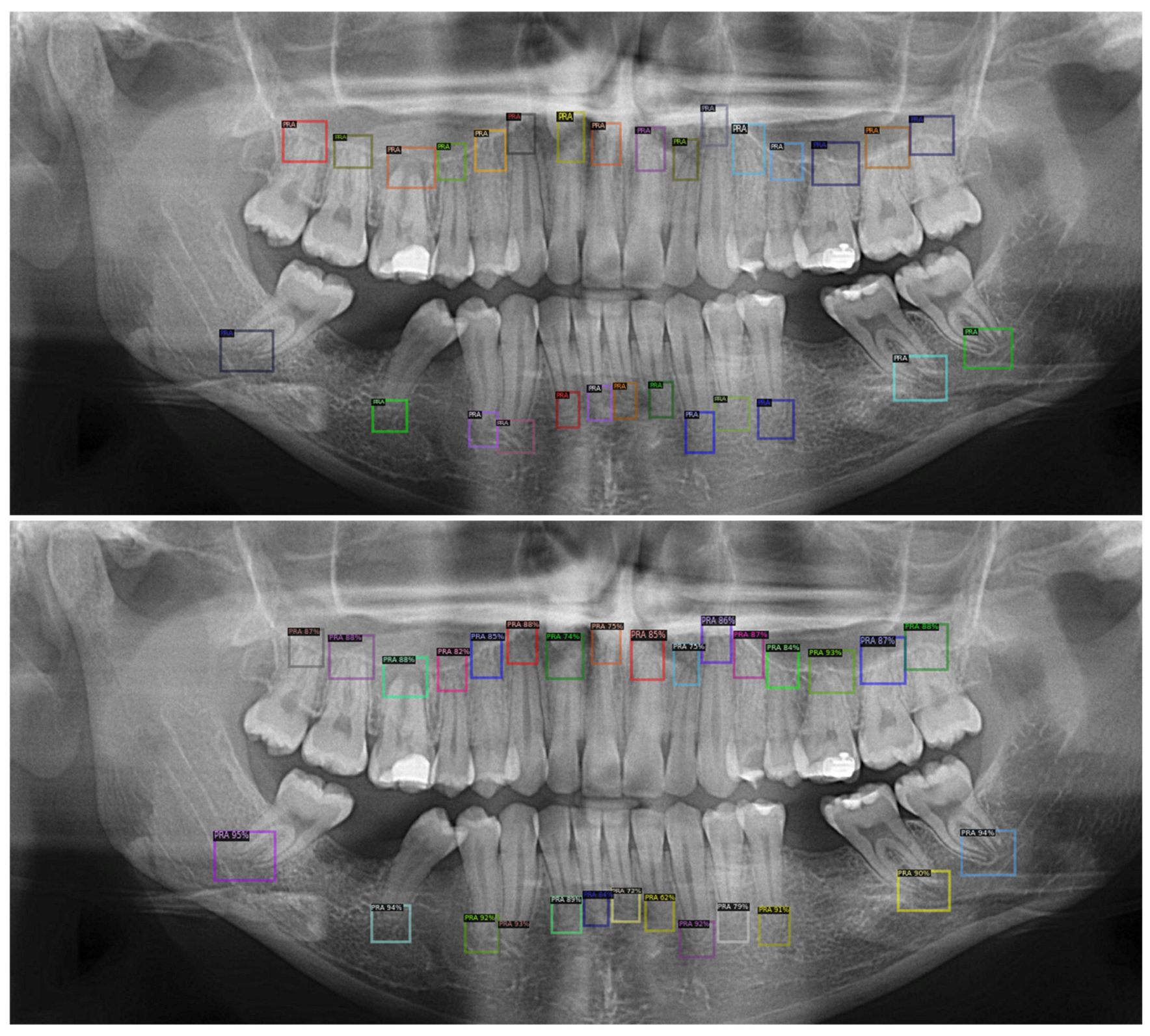 Detection of Periapical Lesions on Panoramic Radiographs Using Deep Learning