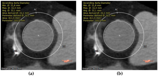 Designing the Optimal Procedure: Role of CT Scan in the Planning of ...