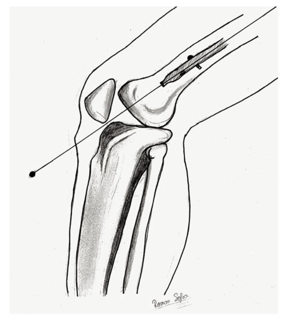 Extraction of Broken Interlocking Tibial Nails: A Review of Surgical ...