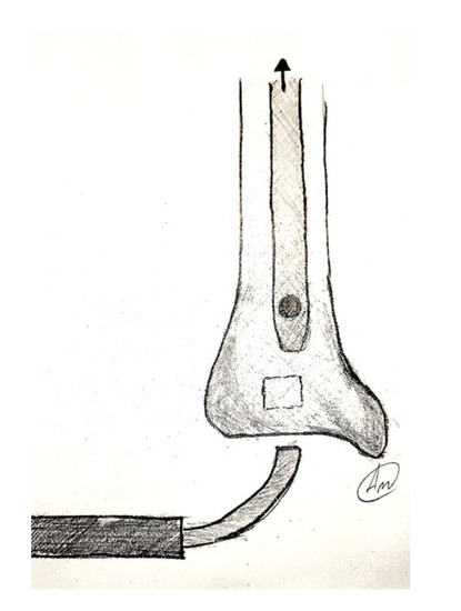 Extraction of Broken Interlocking Tibial Nails: A Review of Surgical ...