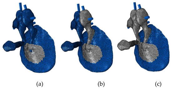 Numerical Study of Tympanosclerosis Including Its Effect on Human Hearing