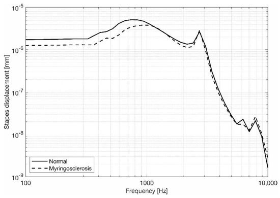Numerical Study of Tympanosclerosis Including Its Effect on Human Hearing