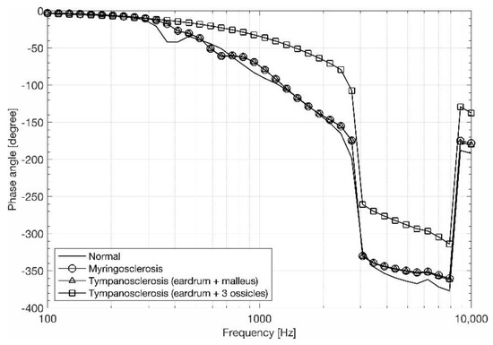 Numerical Study of Tympanosclerosis Including Its Effect on Human Hearing