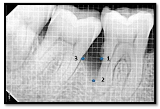 Regeneration of Intrabony Defects with Nano Hydroxyapatite Graft ...