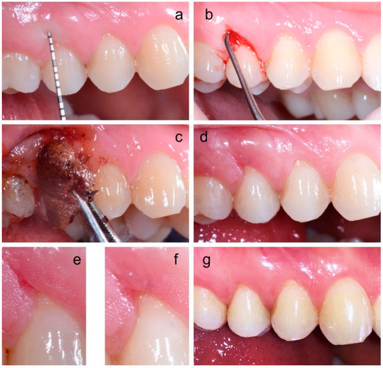 Combining the Non-Surgical Treatment with Extracts of Croton Lechleri ...