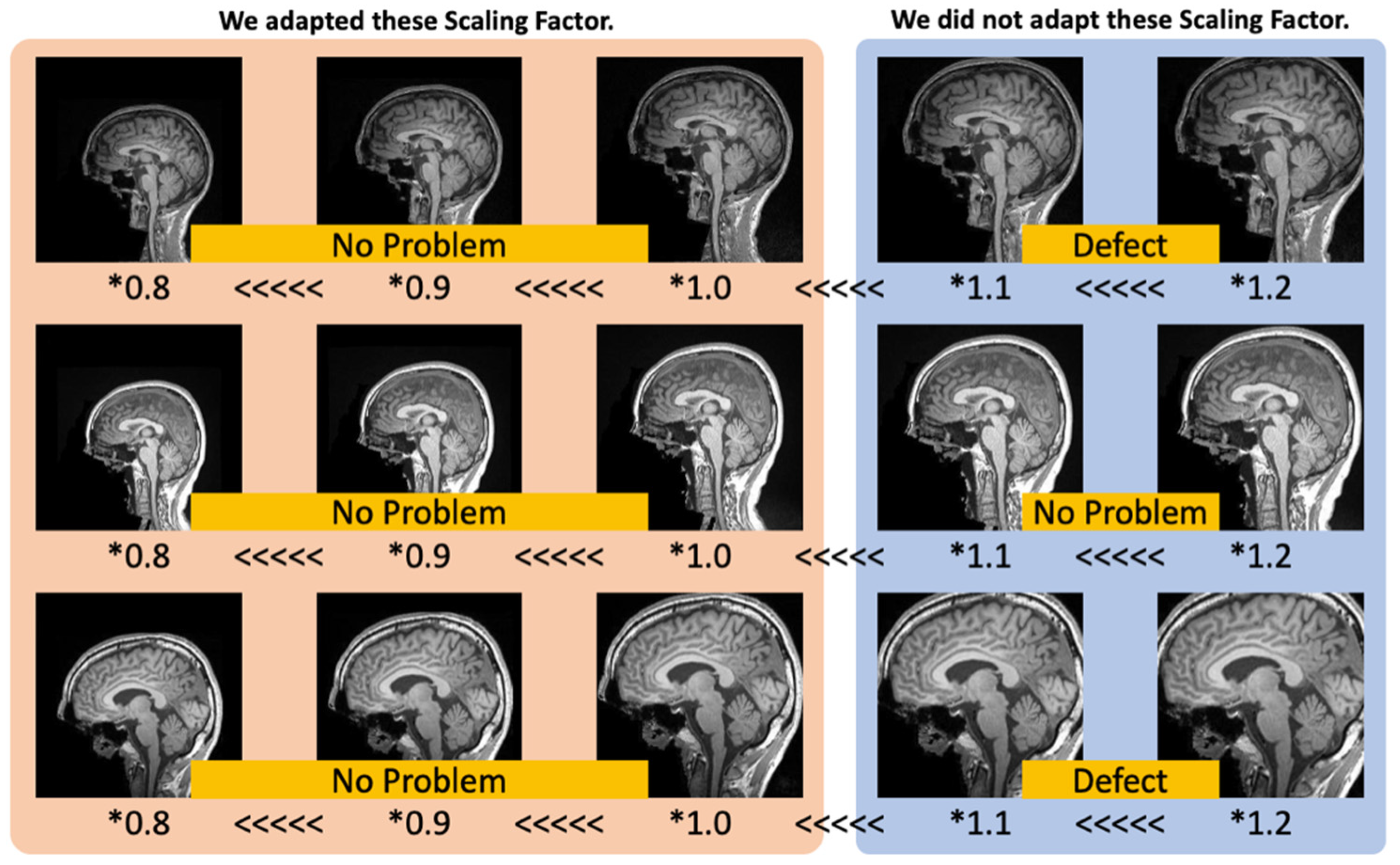 Age Estimation from Brain Magnetic Resonance Images Using Deep Learning ...