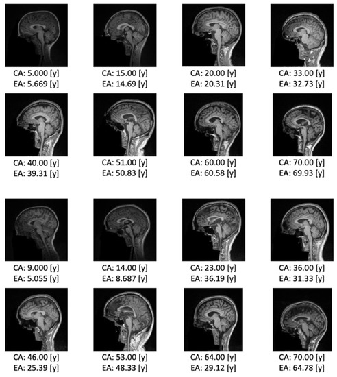 Age Estimation from Brain Magnetic Resonance Images Using Deep Learning ...