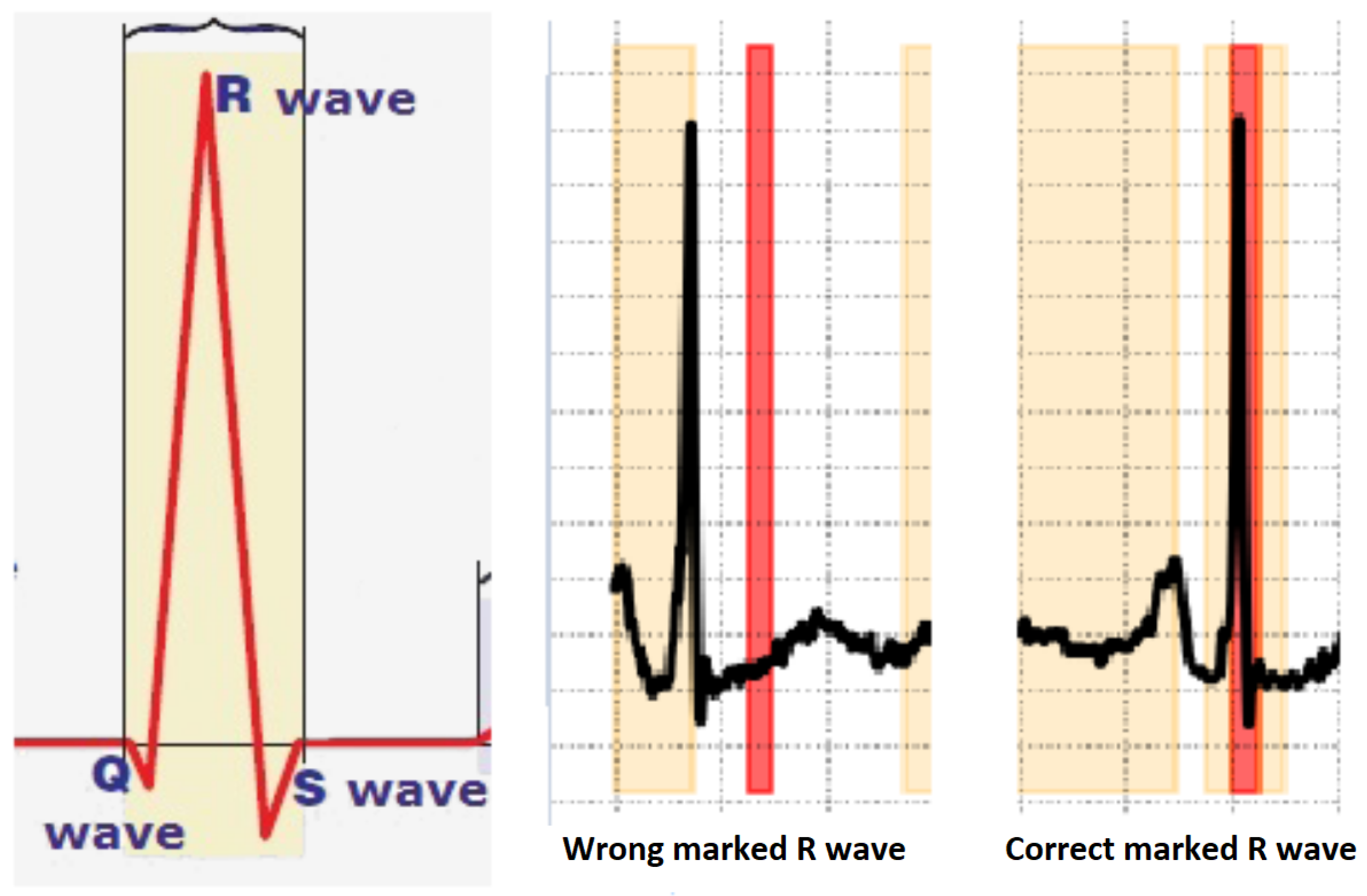 Perturbation-Based Explainable AI for ECG Sensor Data