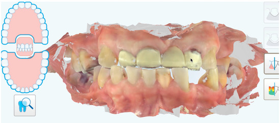 Digital Full-Mouth Reconstruction Assisted by Facial and Intraoral ...