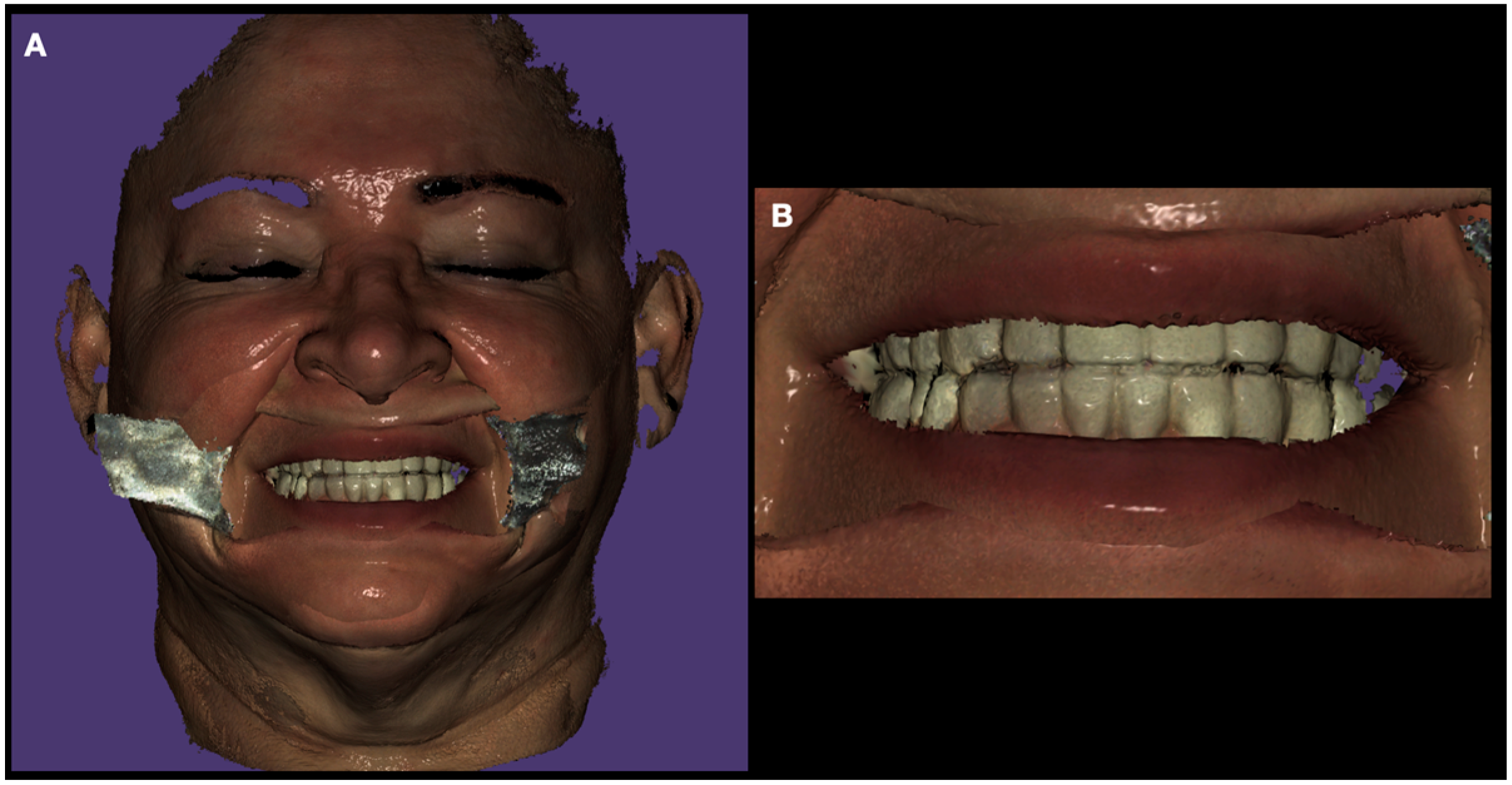 Digital Full-Mouth Reconstruction Assisted by Facial and Intraoral Scanners: A Case Report and ...