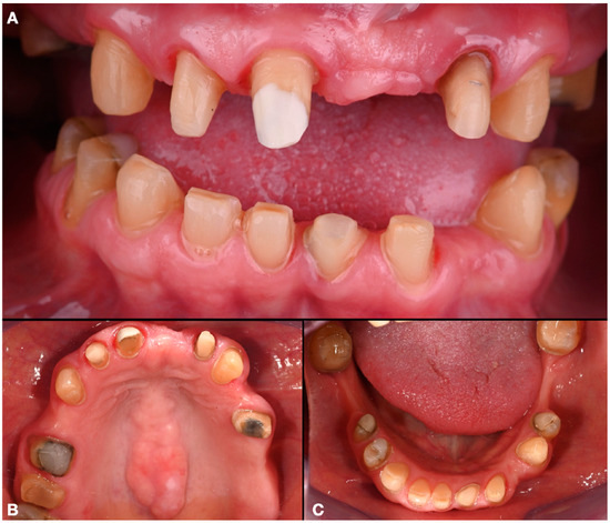 Digital Full-Mouth Reconstruction Assisted by Facial and Intraoral ...