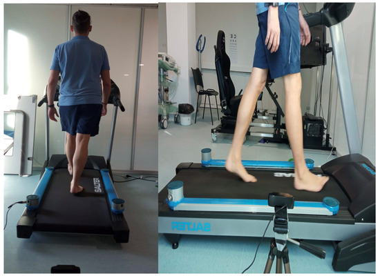 Differences in the Impact of Plantar Fasciopathy on the Spatio-Temporal Gait Parameters between ...