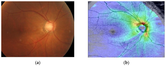 A Glaucoma Detection System Based on Generative Adversarial Network and ...