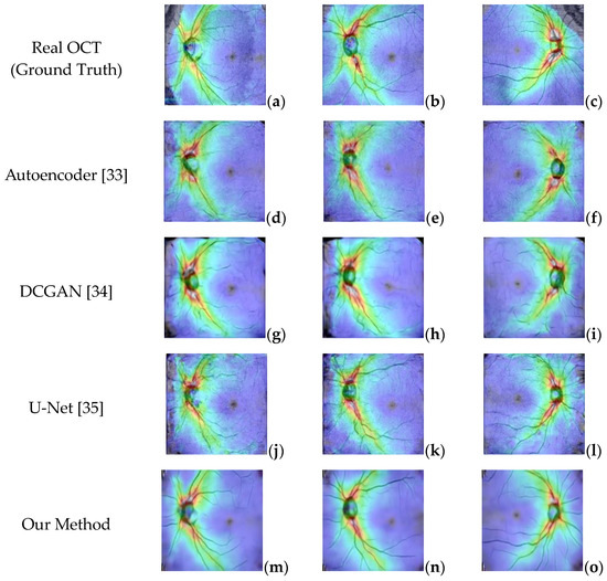 A Glaucoma Detection System Based on Generative Adversarial Network and ...