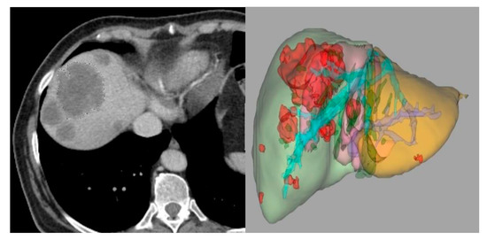 Digital Medical X-ray Imaging, CAD in Lung Cancer and Radiomics in ...